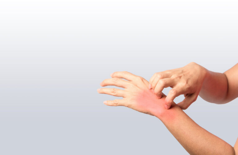 Skin Allergy - Dermacian
